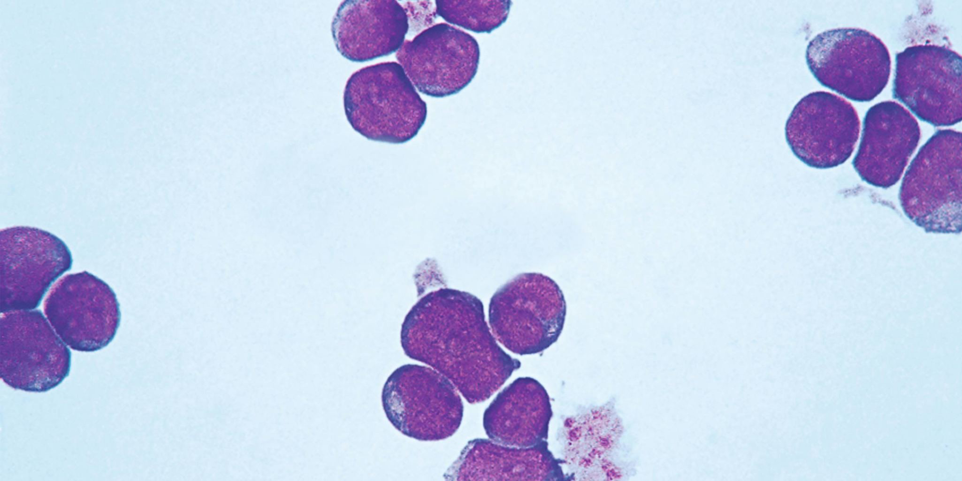 What is AML? | Patients | Cell therapy | Products | Miltenyi Biotec | USA